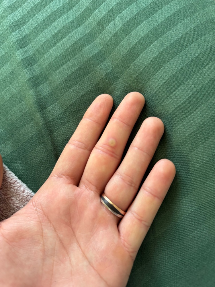 Solutie impotriva negilor, Verolit Forte, 5 ml - eMAG.ro