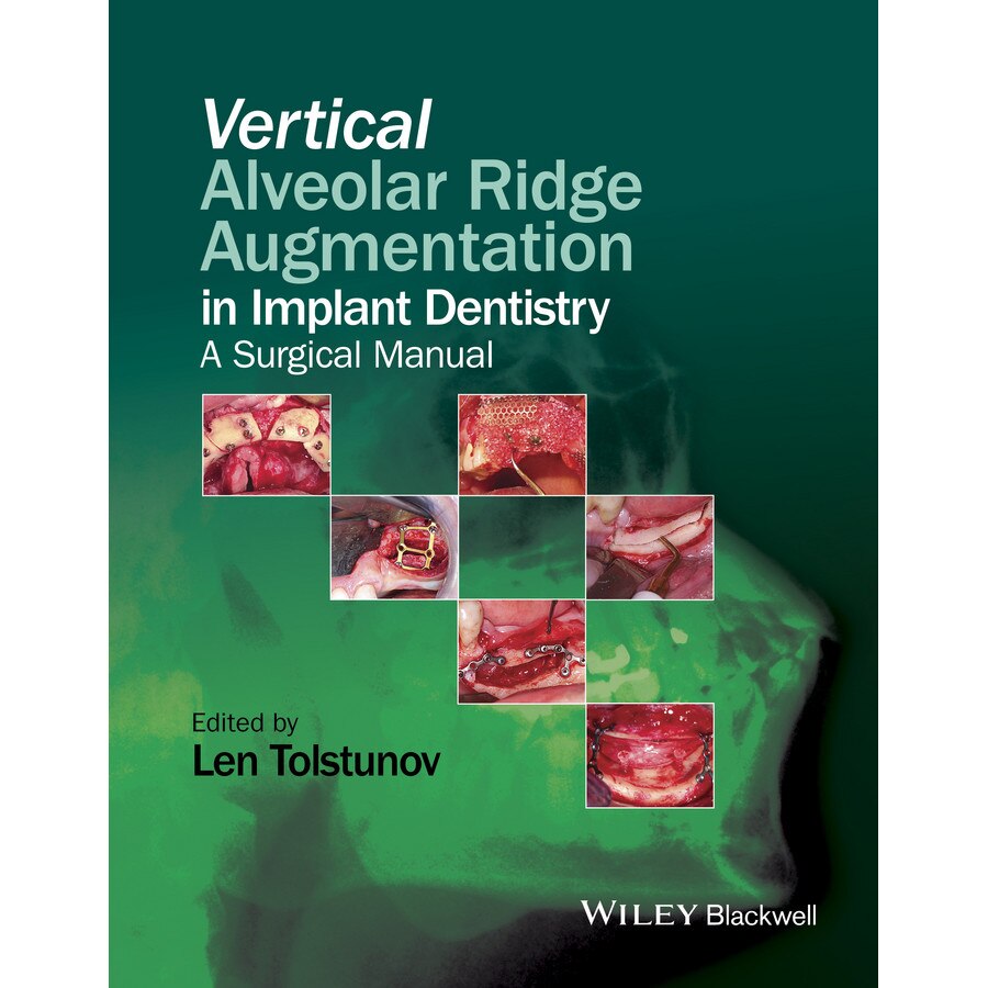 Vertical Alveolar Ridge Augmentation in Implant Dentistry de Len ...