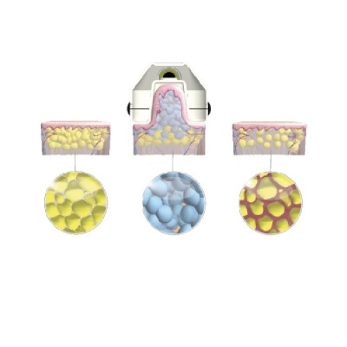 Card cadou tratament slabire localizata cu Criolipoliza Cooltech, 2 ...