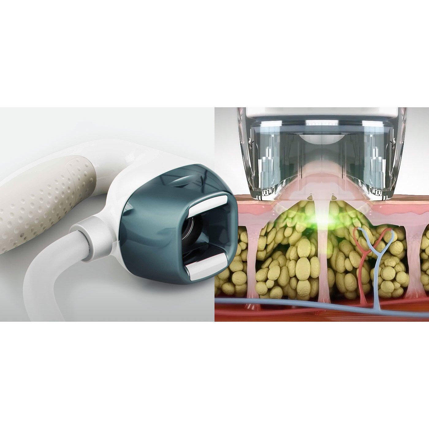 Pachet Contur Mandibular, Criolipoliza Cooltech si VelaShape III ...