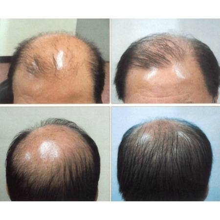 Solutie, Dr. Reddy's, Gain 10, impotriva Caderii Parului, cu ...