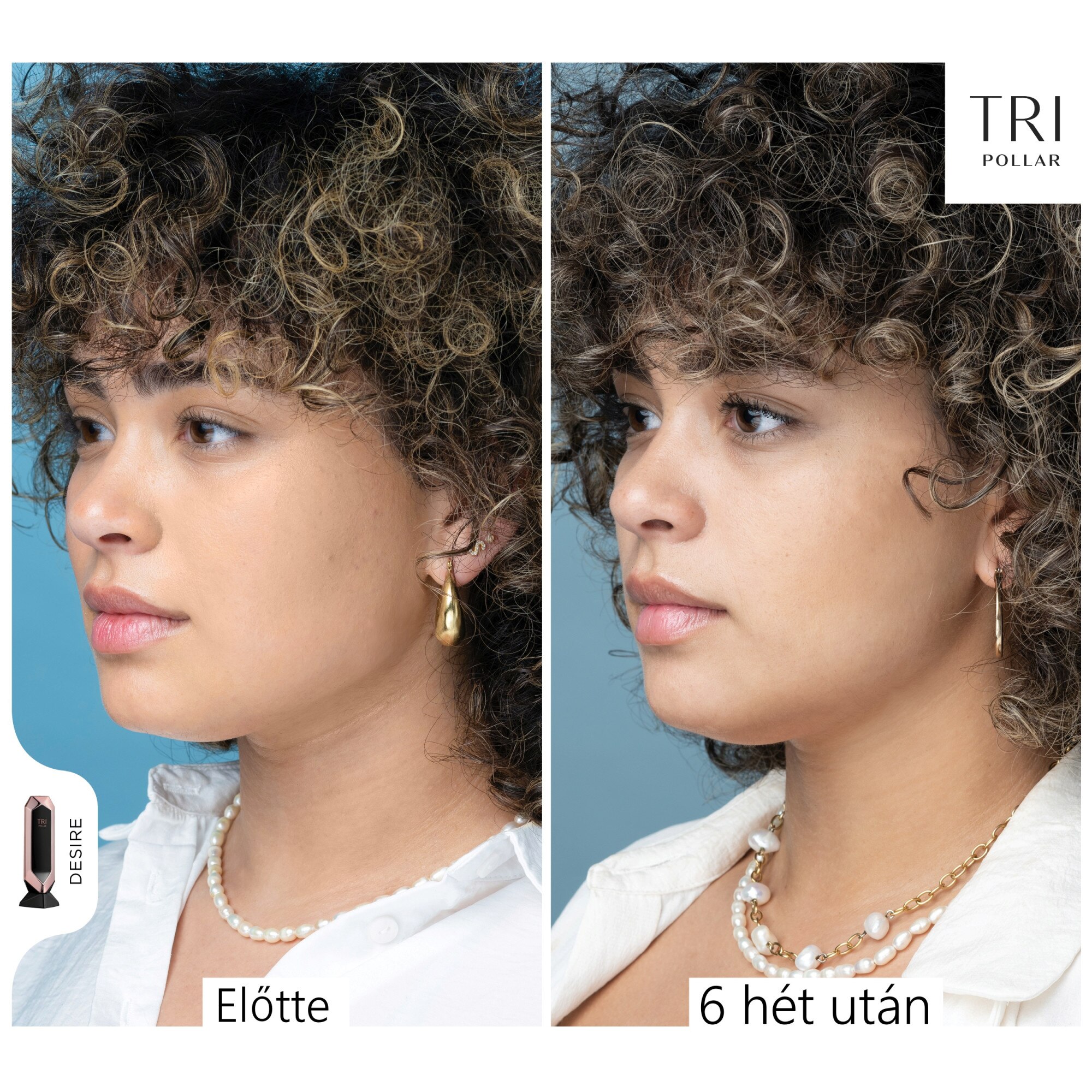 TriPollar DESIRE MULTI-RF, TURBO RF rádiófrekvencia, 3D hőtérképezés ...