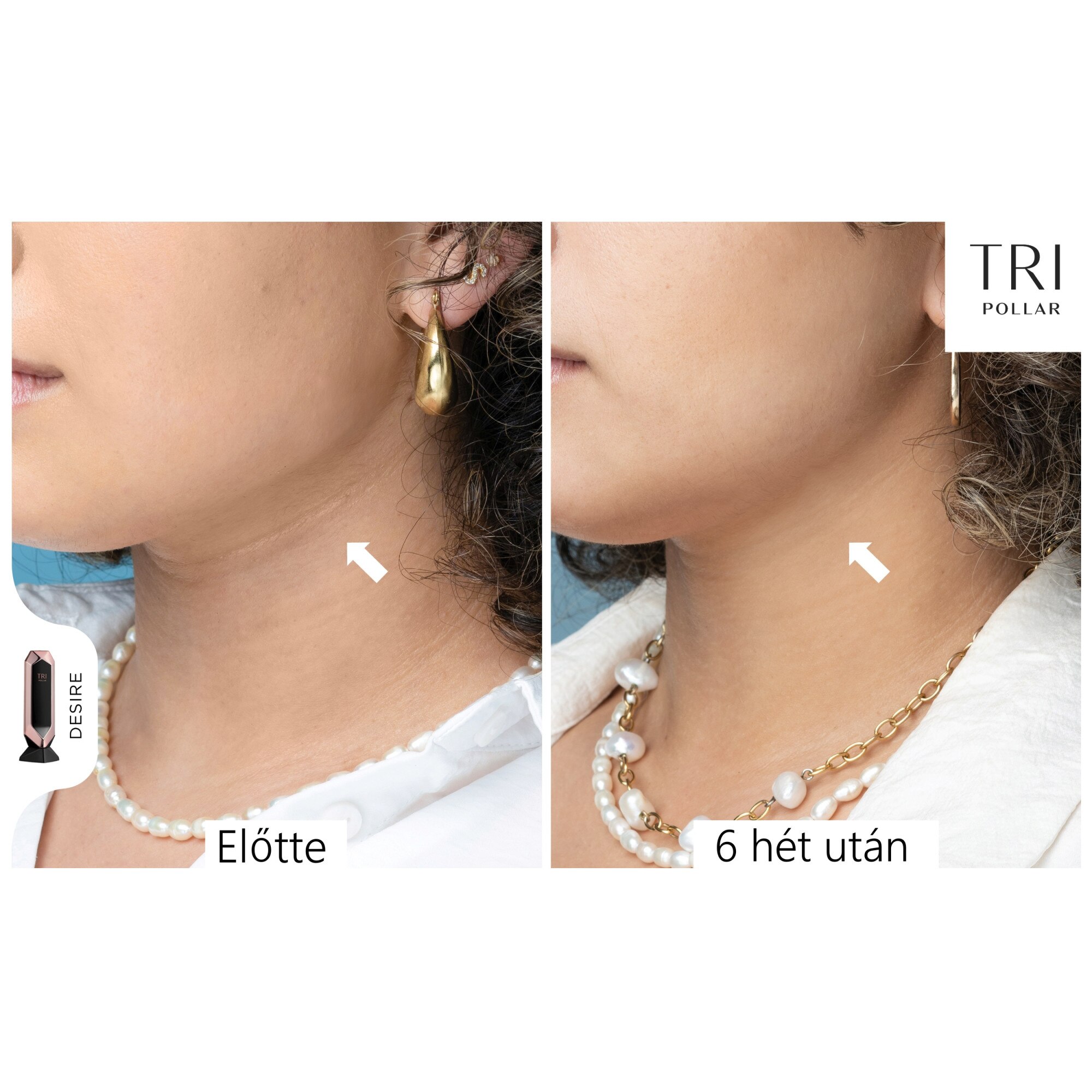 TriPollar DESIRE MULTI-RF, TURBO RF rádiófrekvencia, 3D hőtérképezés ...