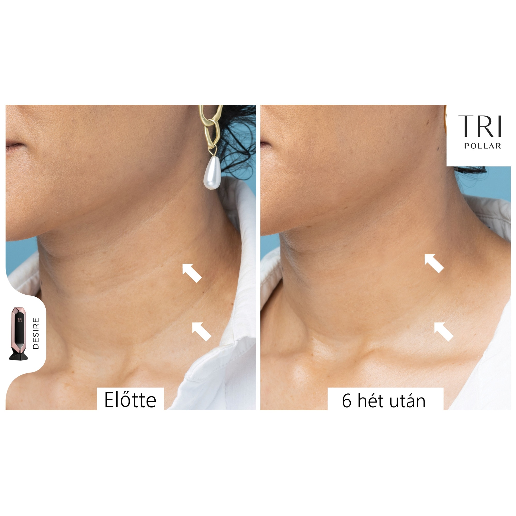 TriPollar DESIRE MULTI-RF, TURBO RF rádiófrekvencia, 3D hőtérképezés ...