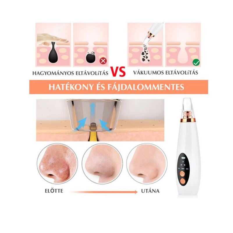 Mitesszer eltávolító szett, CHIGOODS, Fehér - eMAG.hu