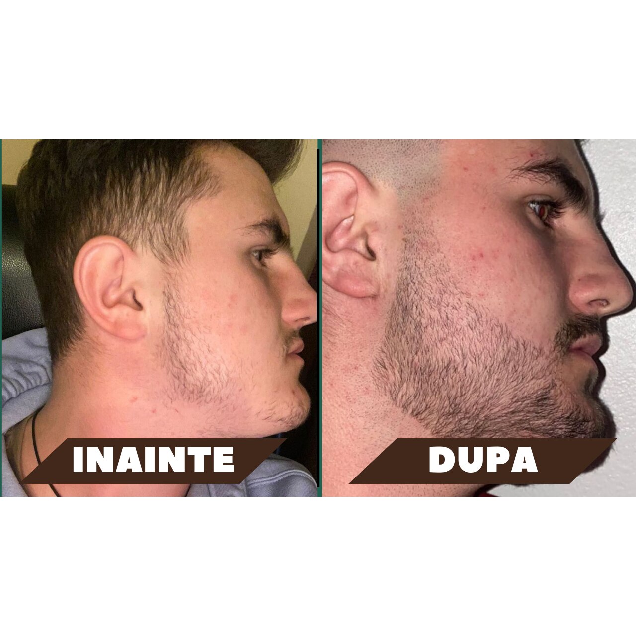 Tratament impotriva caderii parului, Solutie Kirkland Signature, Pipeta ...