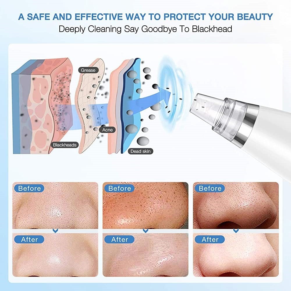 Vákuumos Miteszer-, Szőrtüsző- és Pattanáseltávolító Készülék, fehér ...