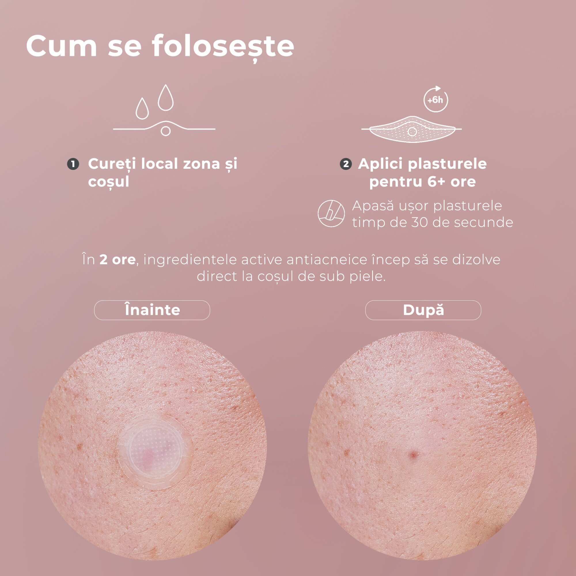 Plasturi Anti Acnee pentru Cosuri Adanci, cu Microcristale ...