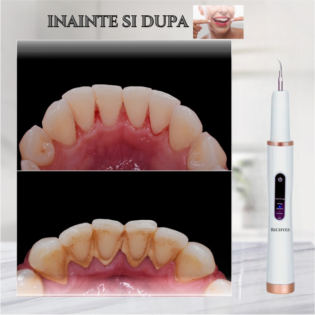 Aparat pentru Detartraj, Richyes®, Dispozitiv pentru Eliminare Tartru ...