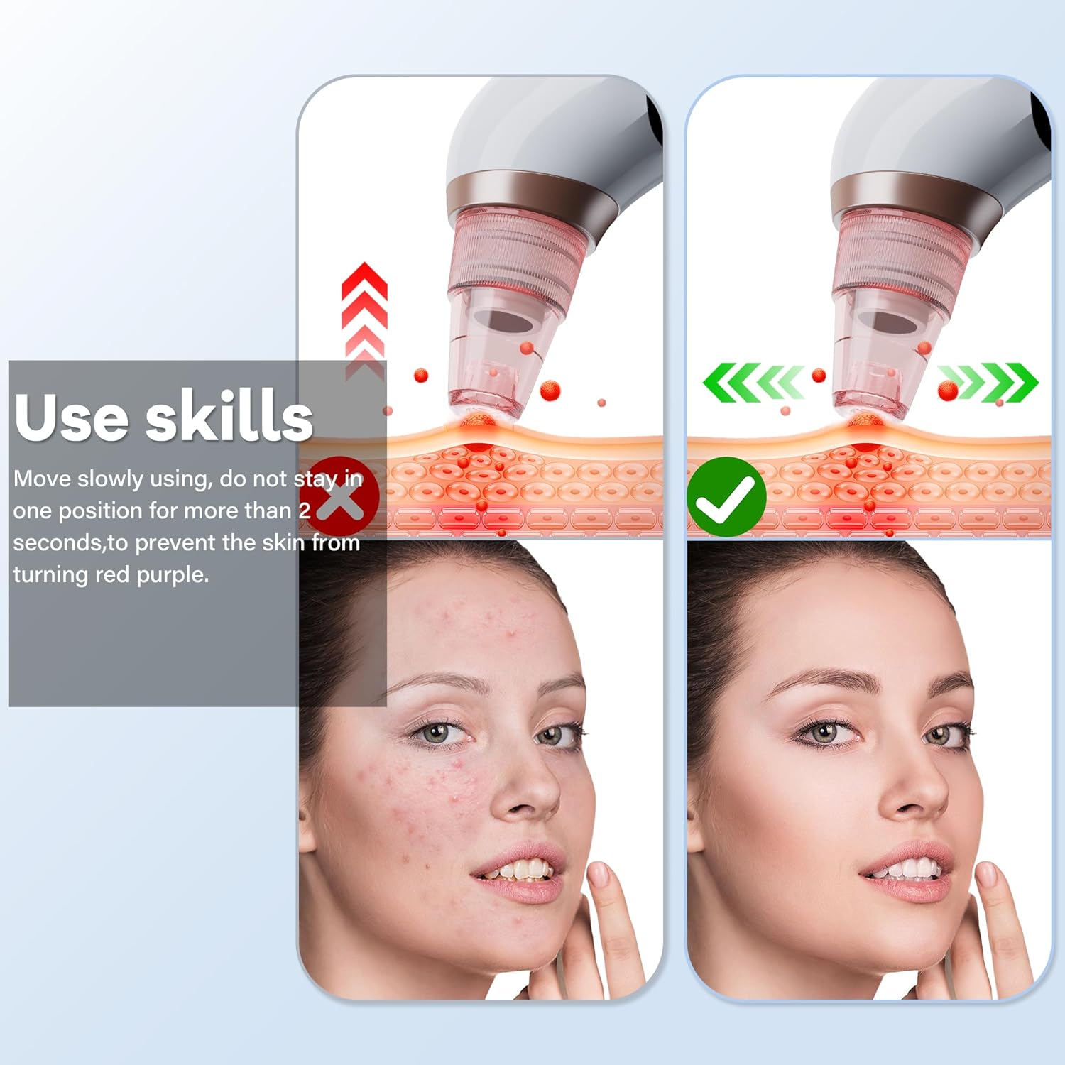 Aparat indepartat puncte negre, de grasime, cu vacuum, MOSMAOO®, 3 ...