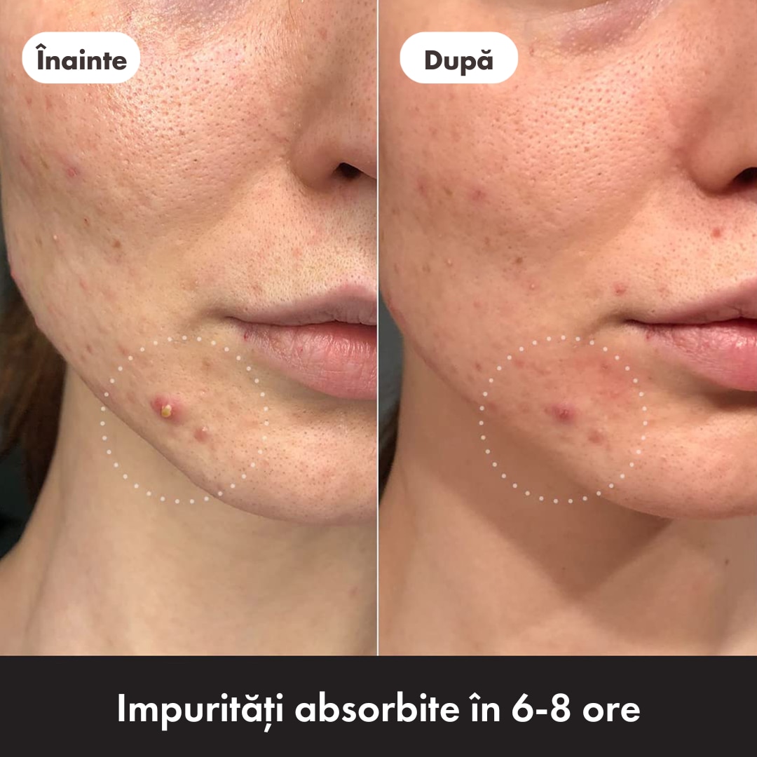 Plasturi hidrocoloidali anti acnee Hero Mighty Patch The Original ...