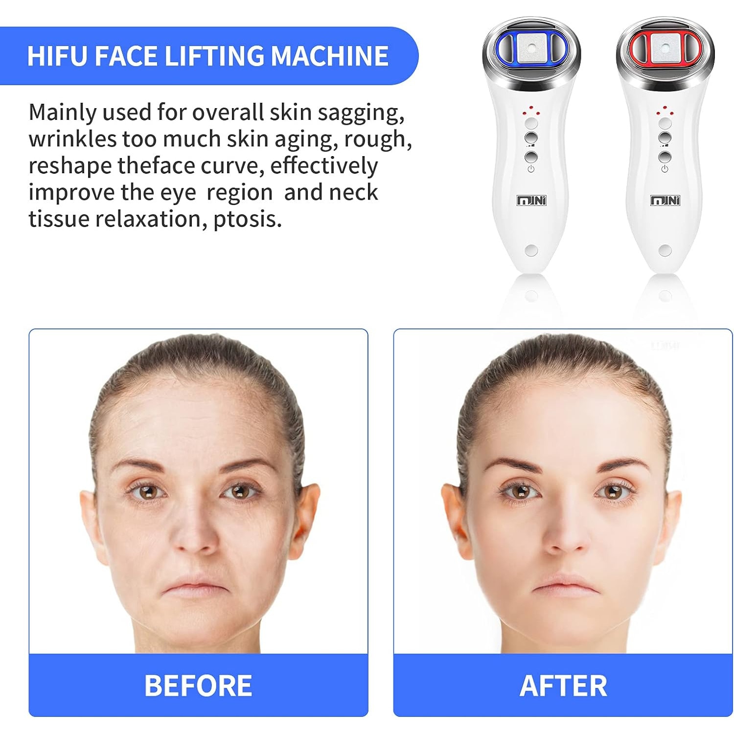 Aparat facial cu ultrasunete anti-imbatranire, MOSMAOO®, Mini Hifu ...