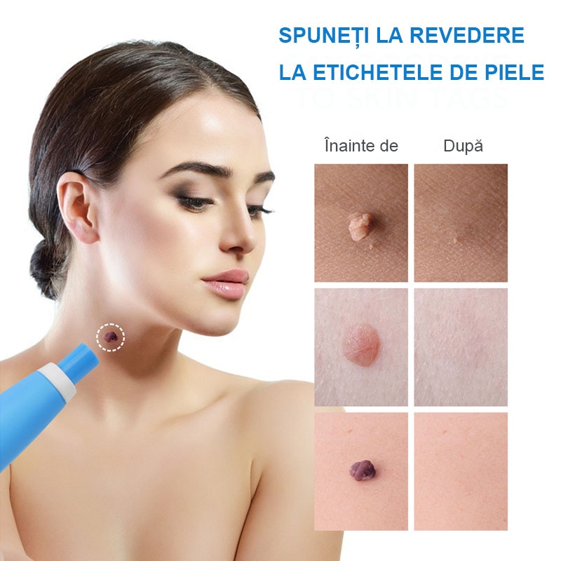 Dispozitiv Indepartare Papiloame prin Ligaturare, pentru Fata, Gat ...