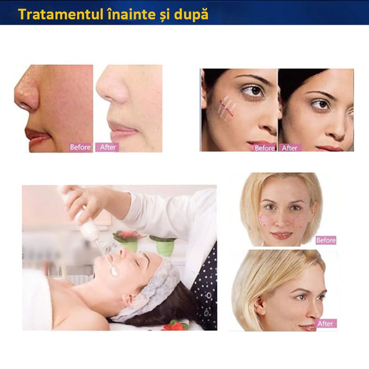 Electroderm cosmetic portabil cu 4 electrozi, Tratament cu Frecventa ...