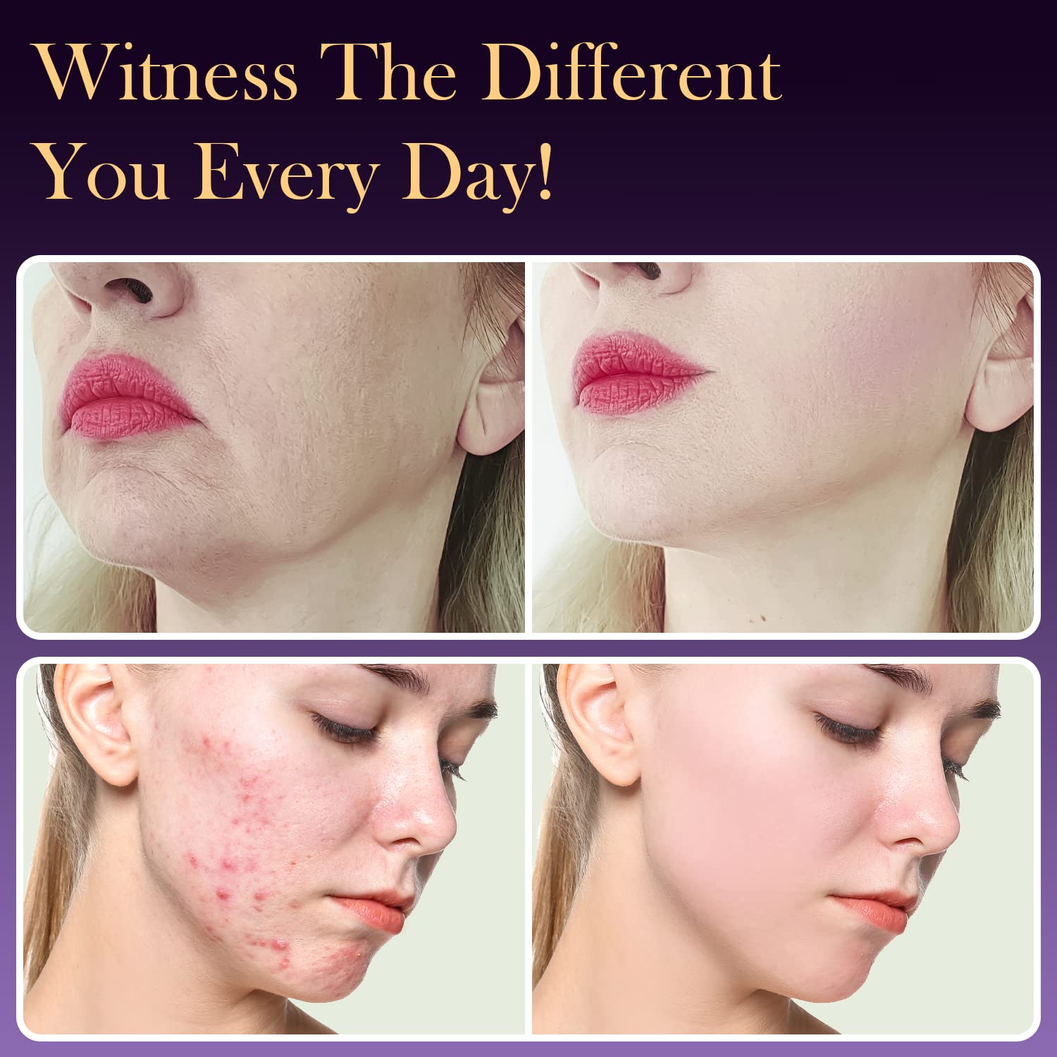 Electroderm за козметично лечение, Excitat®, Високочестотно лечение за ...