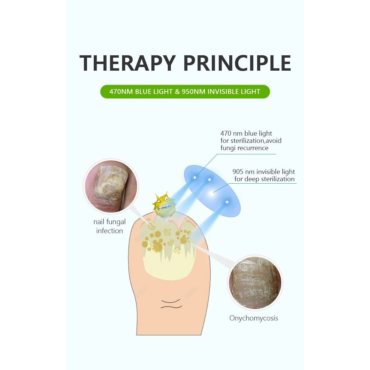 Dispozitiv laser pentru indepartare onicomicoza, ciupercii unghiilor ...