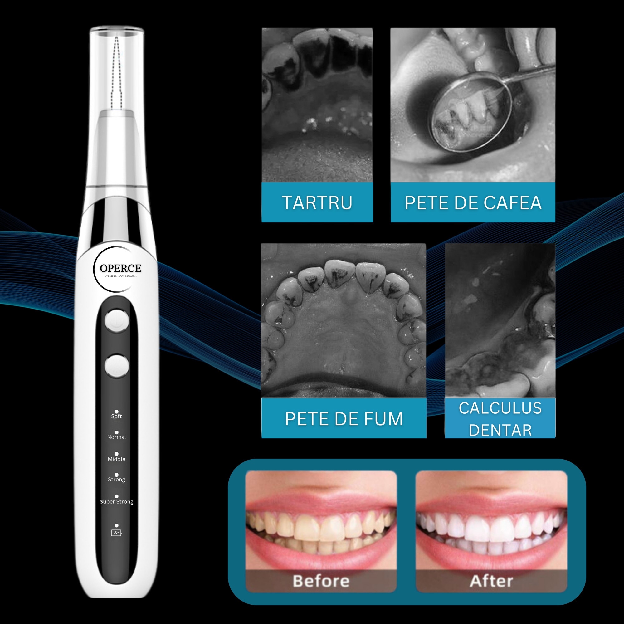 Aparat pentru Detartraj OPERCE™️, Ingrijire Dentara si Eliminare Tartru ...
