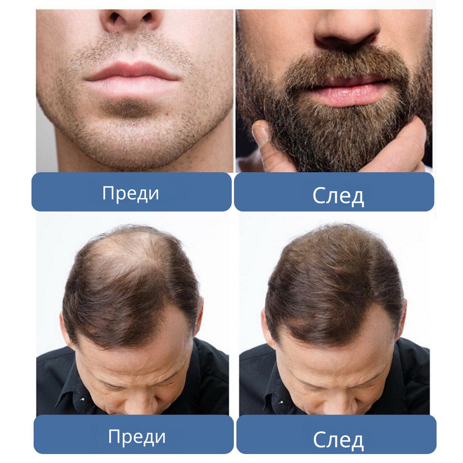Комплект за мъжете Foligain Minoxidil 5%, Против косопад и оплешивяване ...