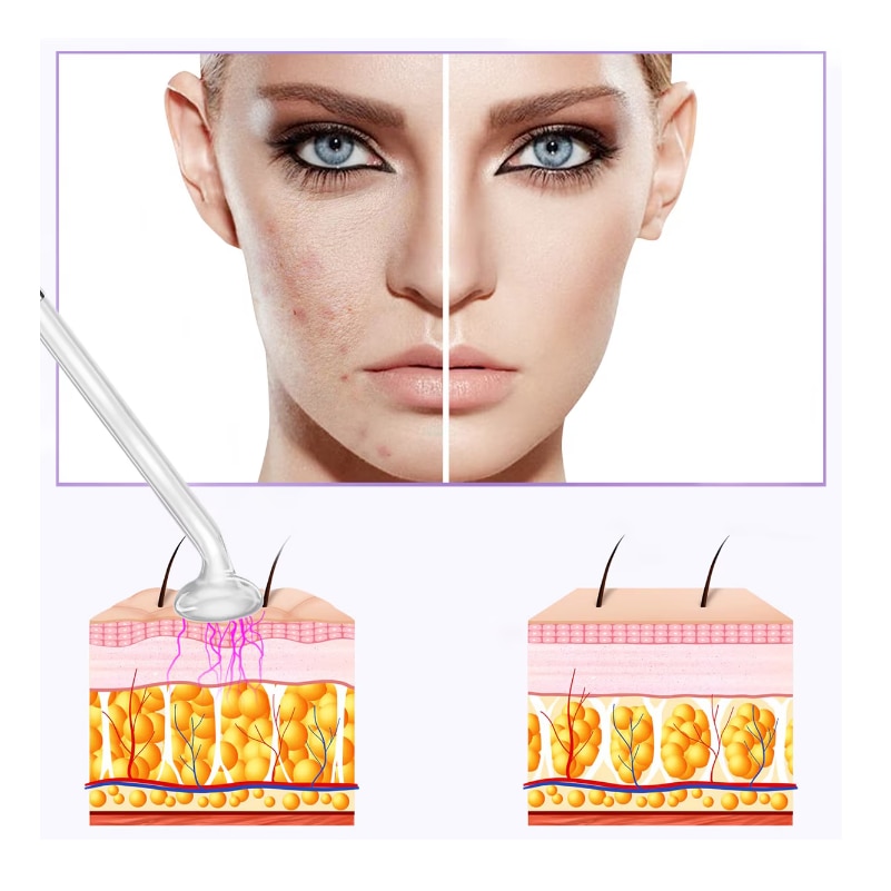 Aparat Electroderm pentru tratament cosmetic, portabil, Tratament cu ...