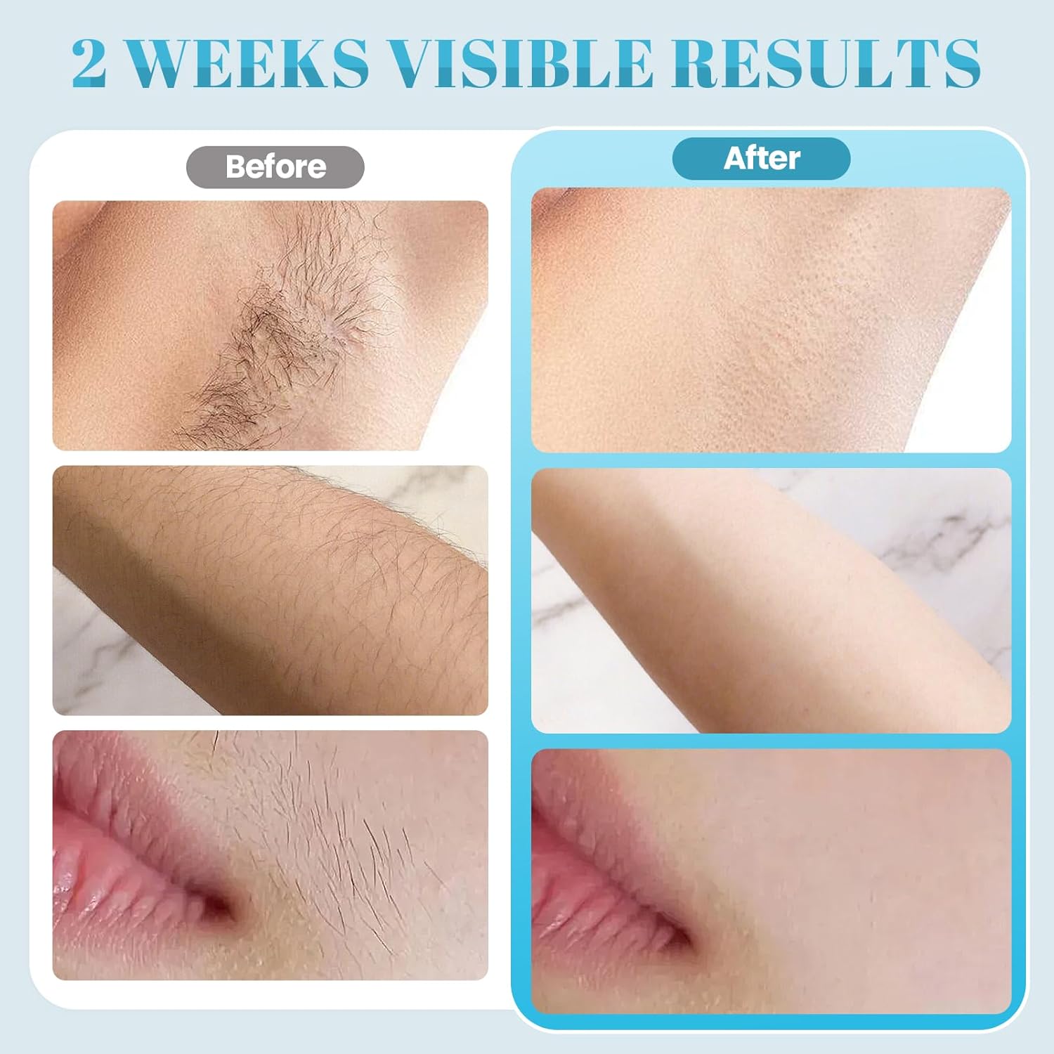 Epilator IPL VINTOP®, 5 Trepte De Intensitate, Pentru Epilare ...