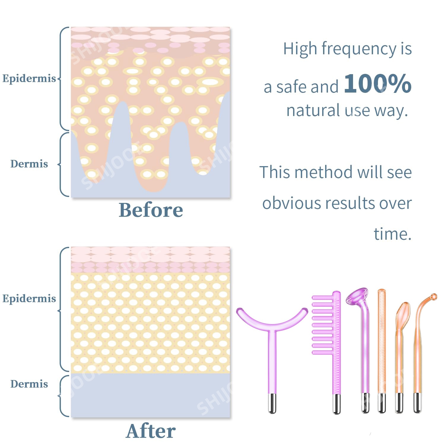 Electroderm Устройство за козметично лечение，SHIJOOE，преносимо，високочестотна аргонова ...