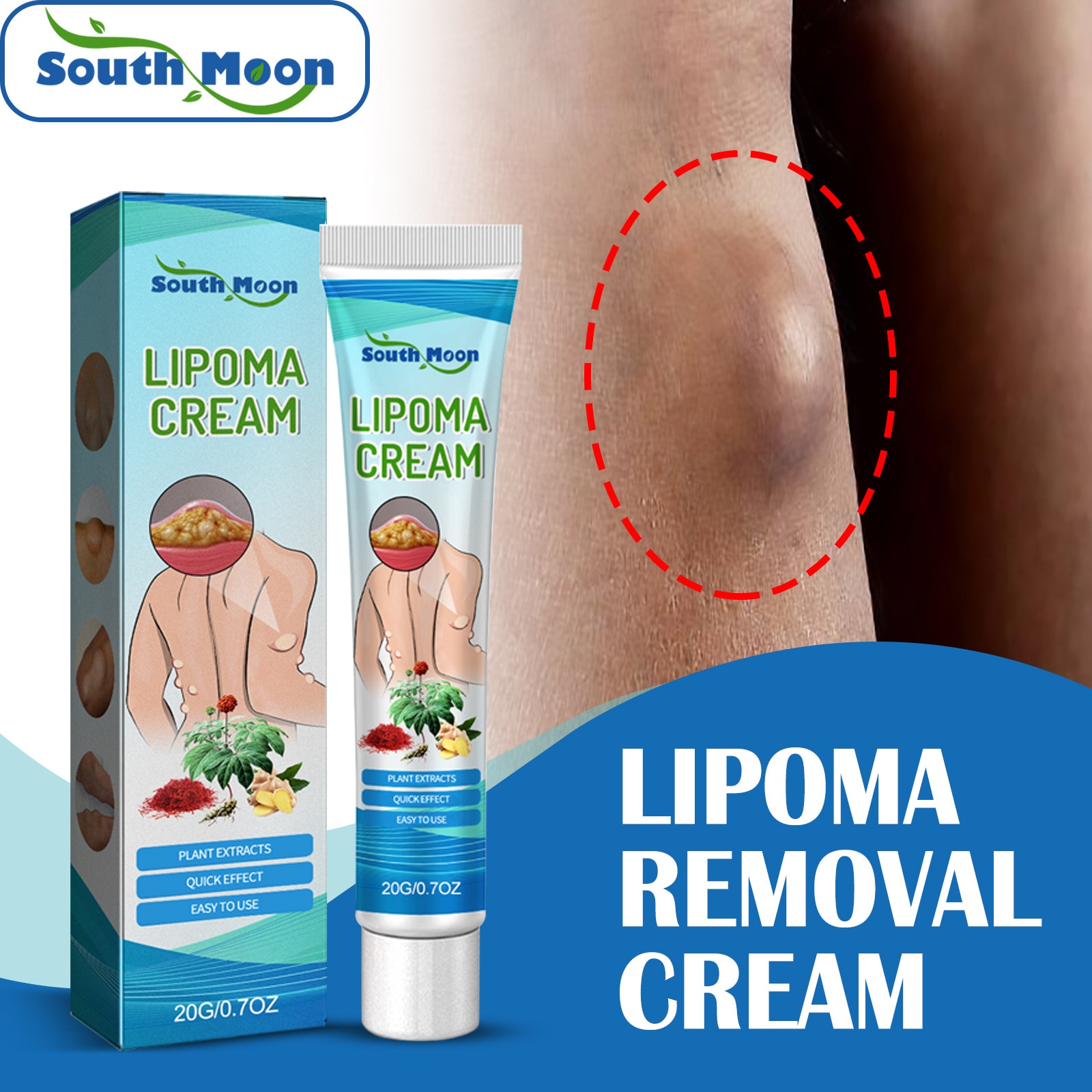 Crema South Moon pentru Chisturi Lipomatosi si Tumefactii Subcutanate ...