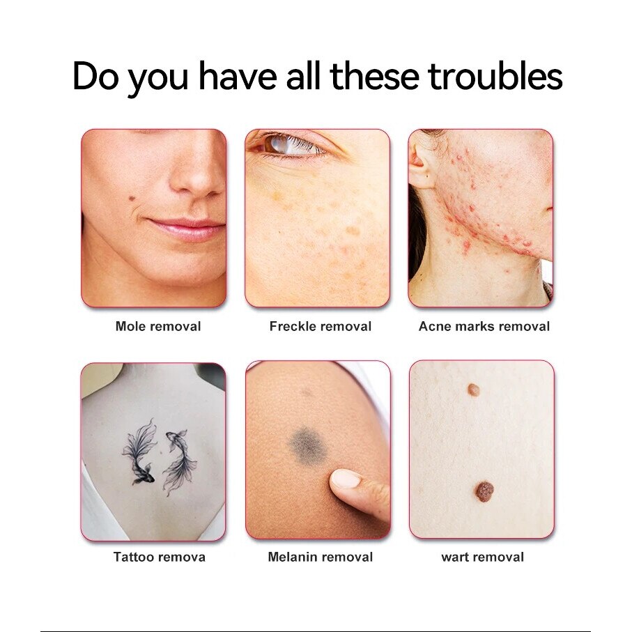 Plazma toll gép, SHIJOOE, 6 cserefej, szemölcsök, anyajegyek, hegek ...