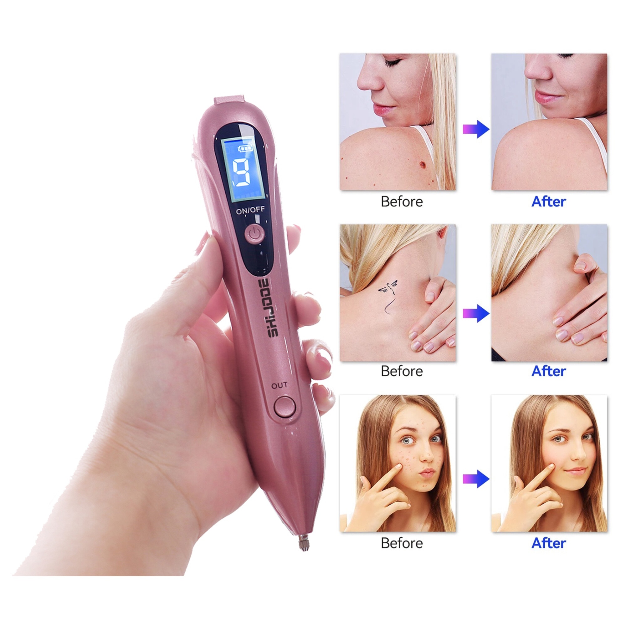 Plazma toll gép, SHIJOOE, 6 cserefej, szemölcsök, anyajegyek, hegek, tetoválások, szeplők ...