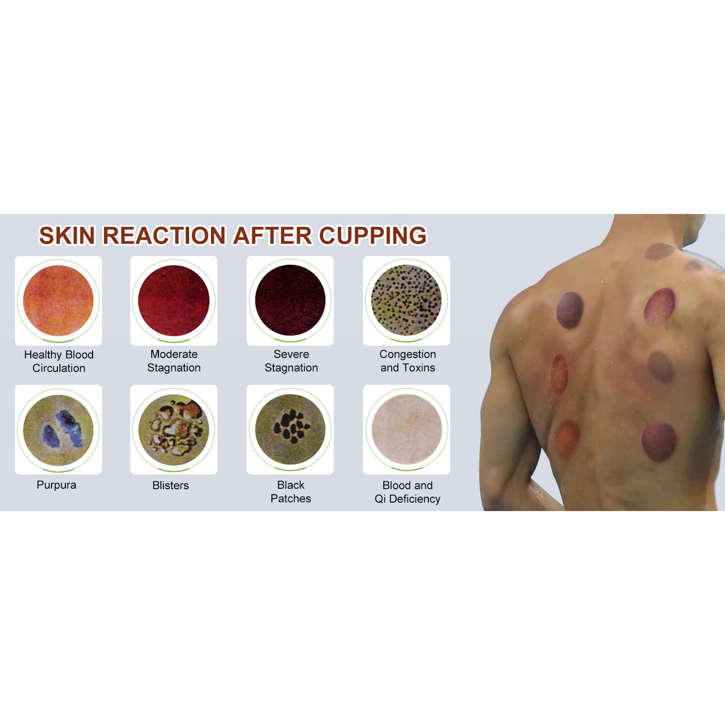 Set 18 ventuze masaj，SHIJOOE®，Vacuum fara foc cu pompa，Functie ...